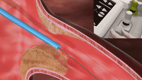 Complex Coronary Interventions – Dr. Ravninder Singh Kuka
