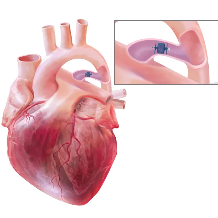 Asd Pda Device Closure Dr Ravninder Singh Kuka